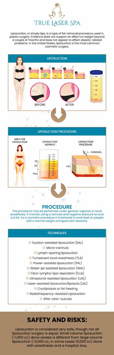 An Introductory Guide to Liposuction in Saint Clair Shores, MI